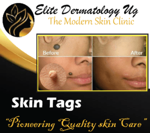 Comprehensive Guide to Skin Tags: Causes, Treatment, and Prevention ...