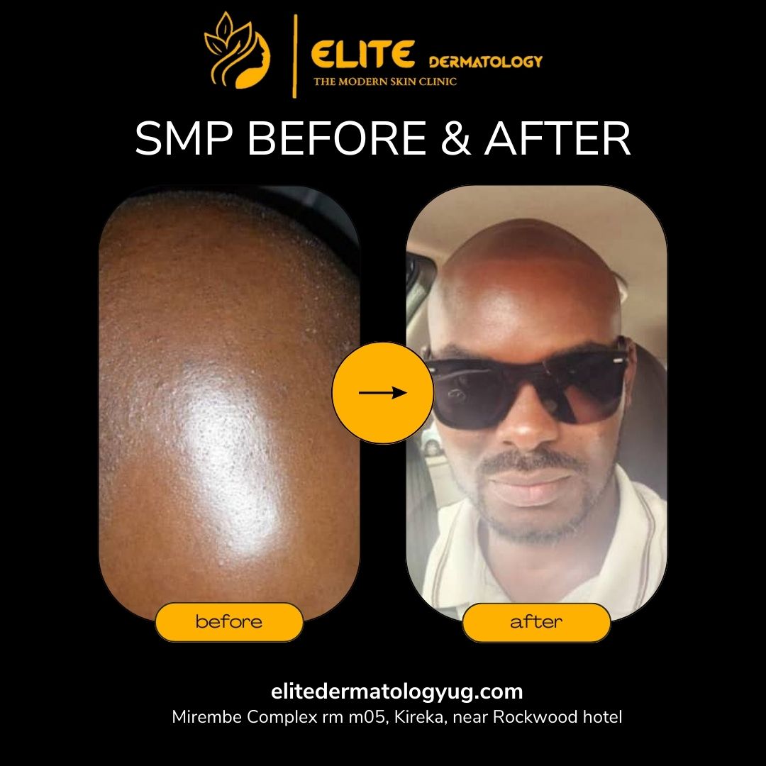 SMP Hair Treatment in Kampala: Rediscovering Confidence at Elite ...